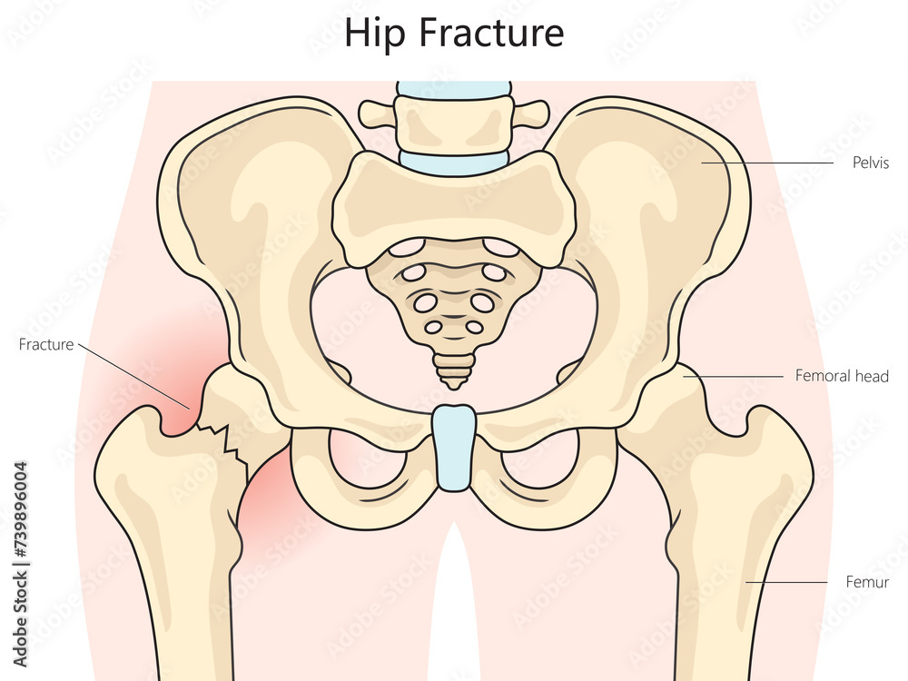 Hip fracture structure diagram hand drawn schematic raster illustration ...