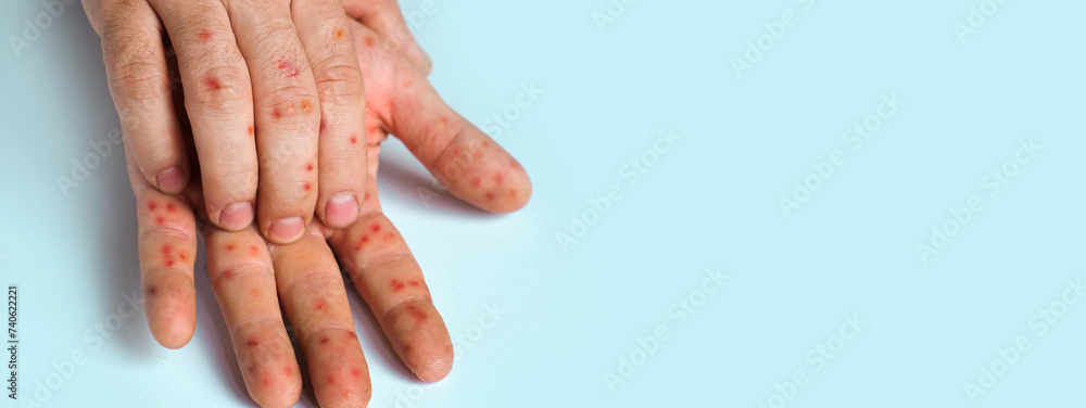 Photo Stock Human Hands with Painful Rash, Red Spots Blisters on the Skin. Health Problem ...