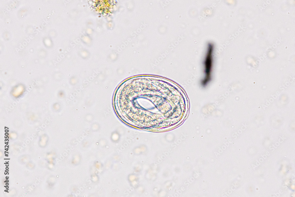 Finding Trichuris trichiura egg and Strongyloides egg in the feces ...