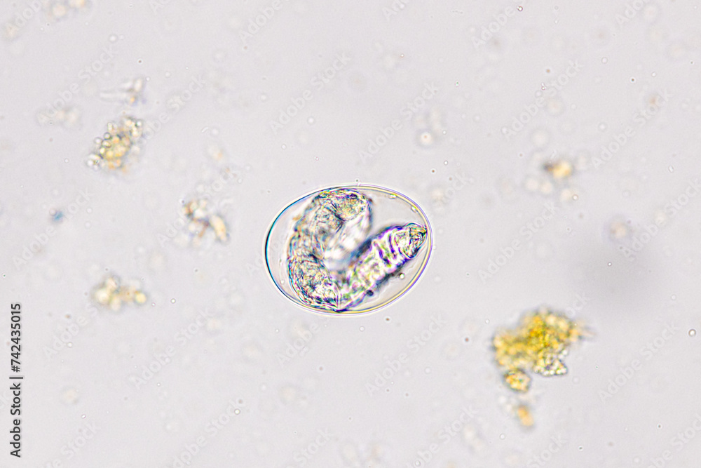 Finding Trichuris trichiura egg and Strongyloides egg in the feces ...