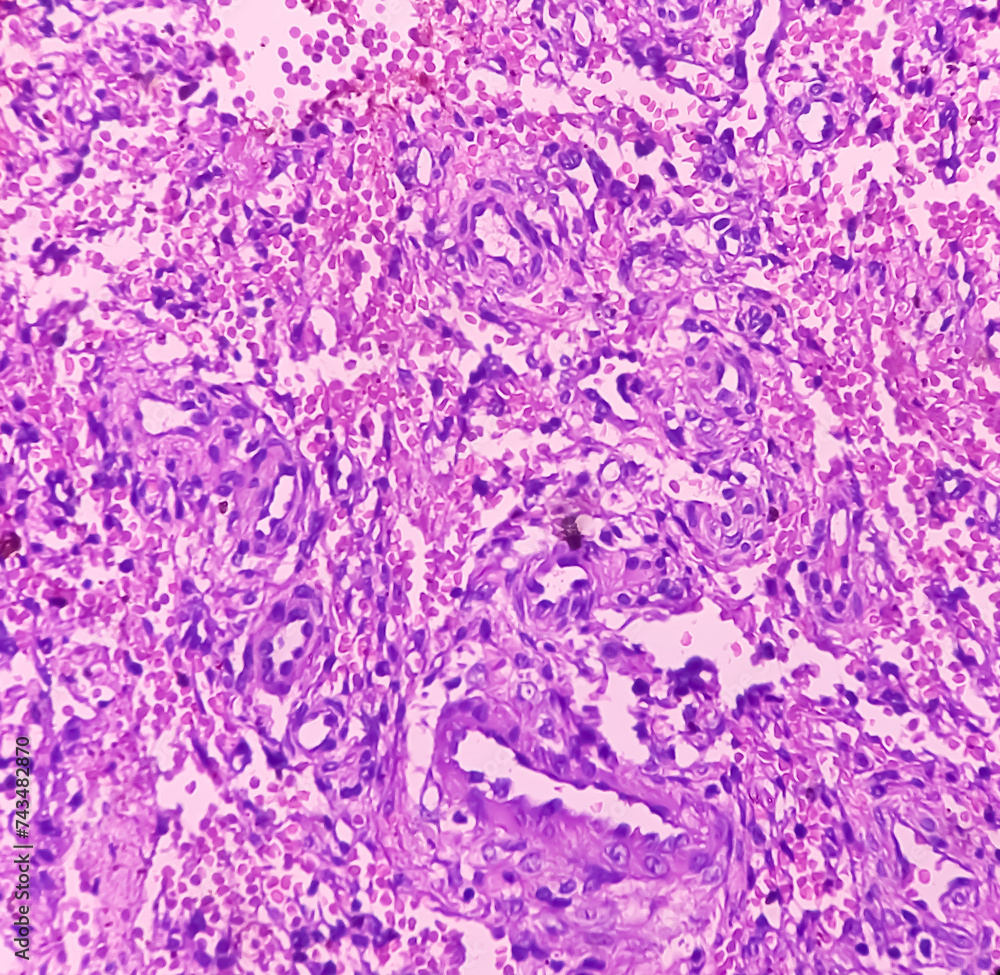 Ovarian cyst: Haemorrhagic cyst. Microscopic show ovarian cyst wall of ...