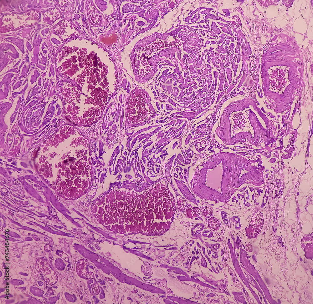 Ovarian cyst: Haemorrhagic cyst. Microscopic show ovarian cyst wall of ...