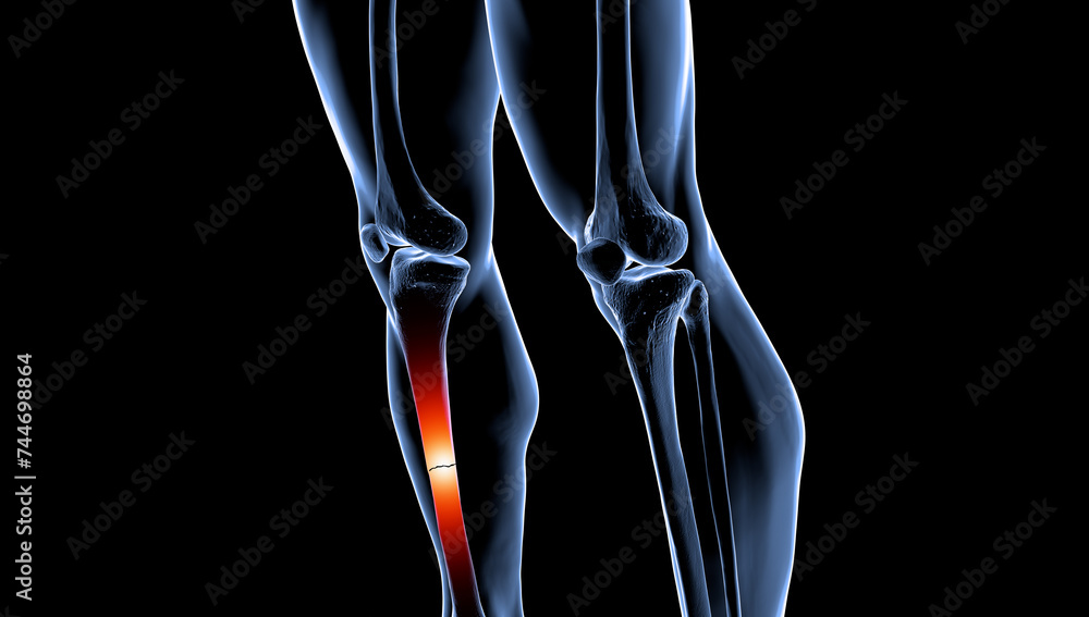 Medical Illustration of Broken Tibial on Human Male Skeleton の Stock ...