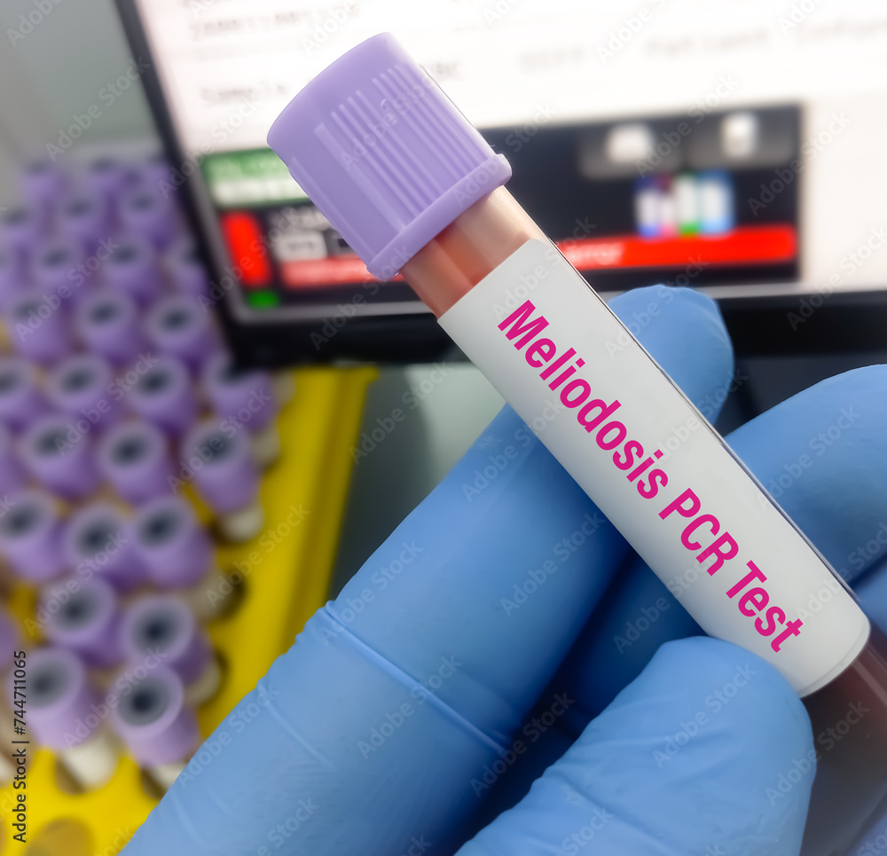 Blood sample for Melioidosis PCR test, also called Whitmore's disease ...
