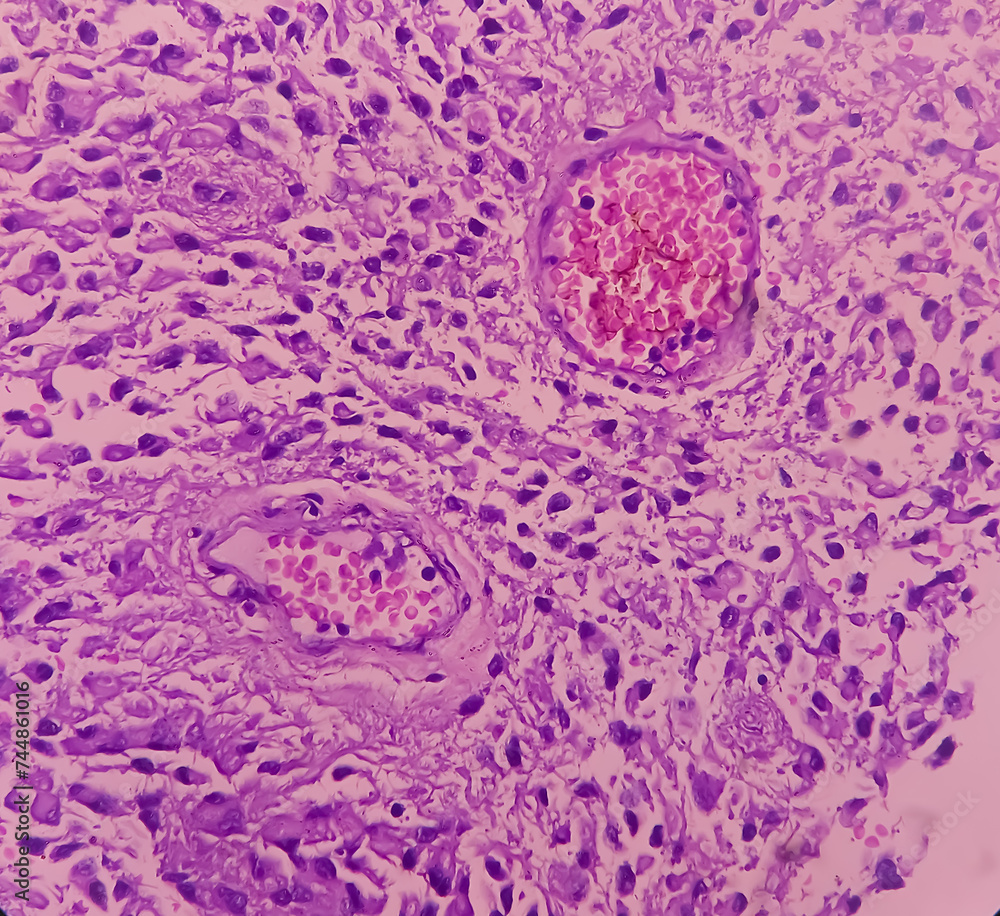 Stock Foto „mature Cystic Teratoma Ovarian Cyst Biopsy Show Cyst Wall