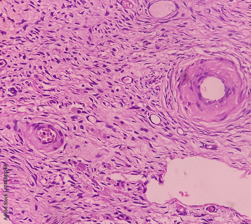 Uterus with adnexa (biopsy): Cervix show chronic inflamatory cells ...