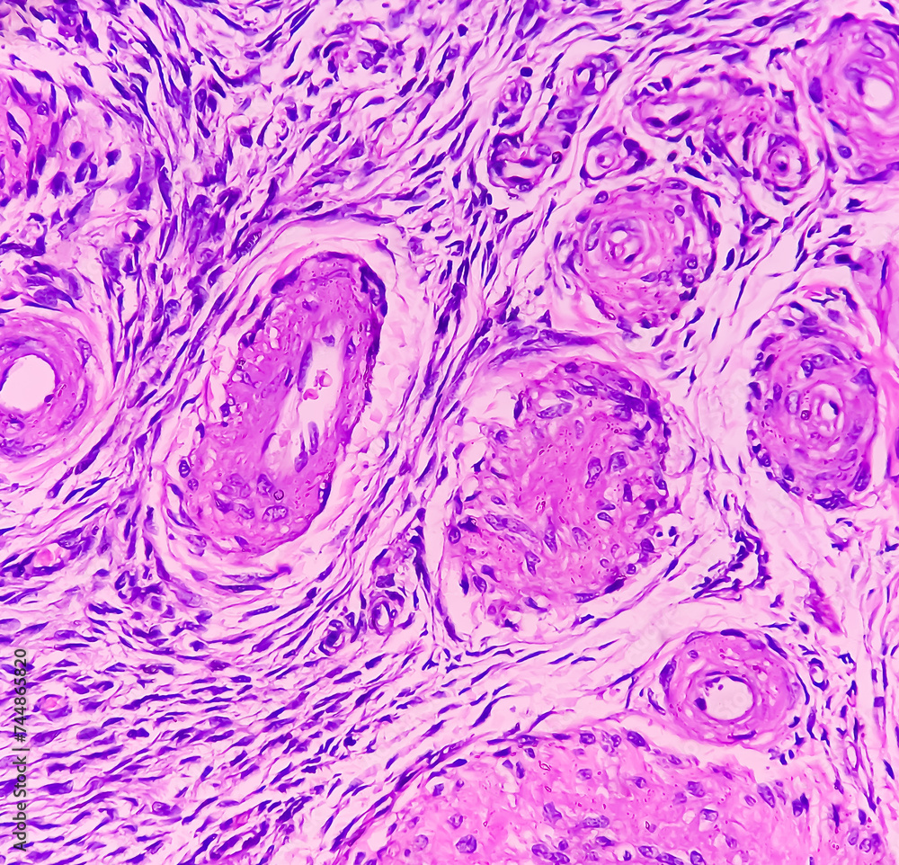 Foto de Stock Uterus with adnexa (biopsy): Cervix show chronic ...