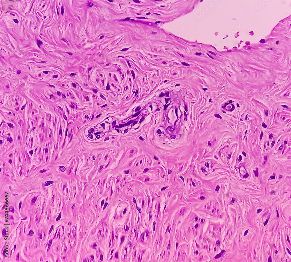 Photo Stock Uterus with adnexa (biopsy): Cervix show chronic ...