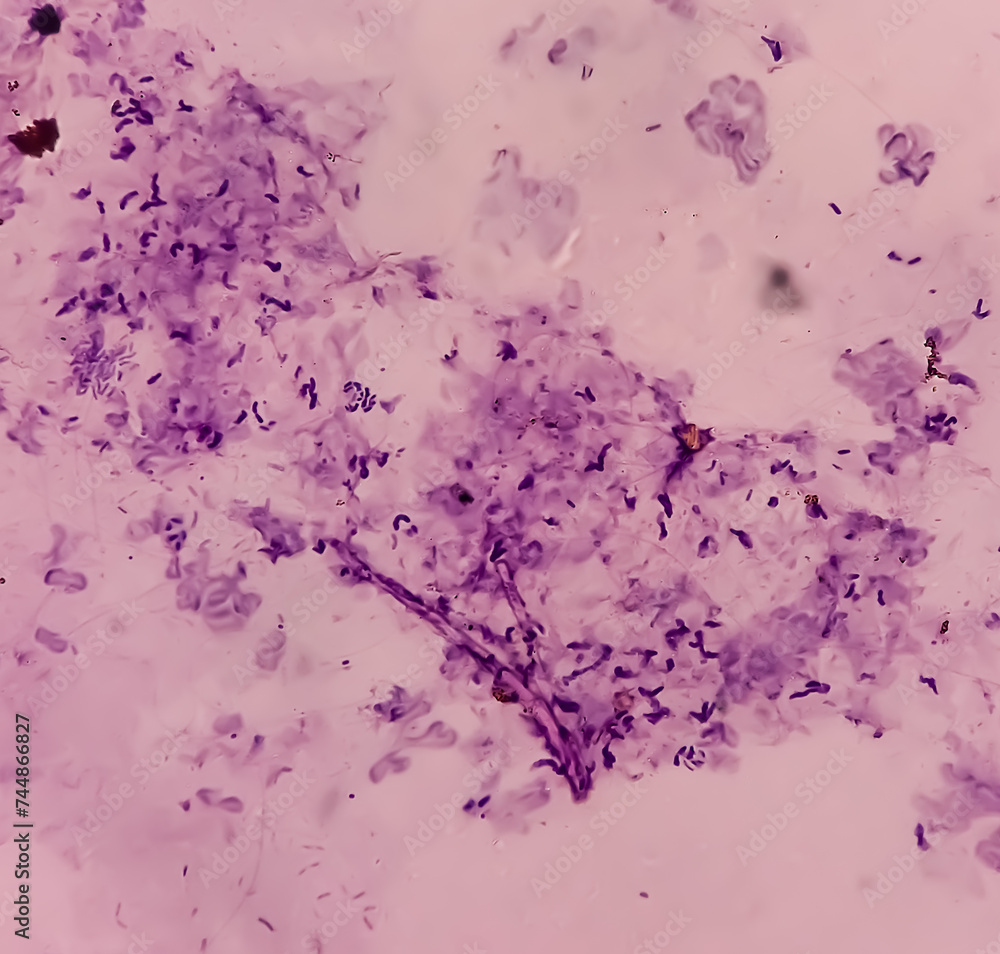 Uterus with adnexa (biopsy): Cervix show chronic inflamatory cells ...