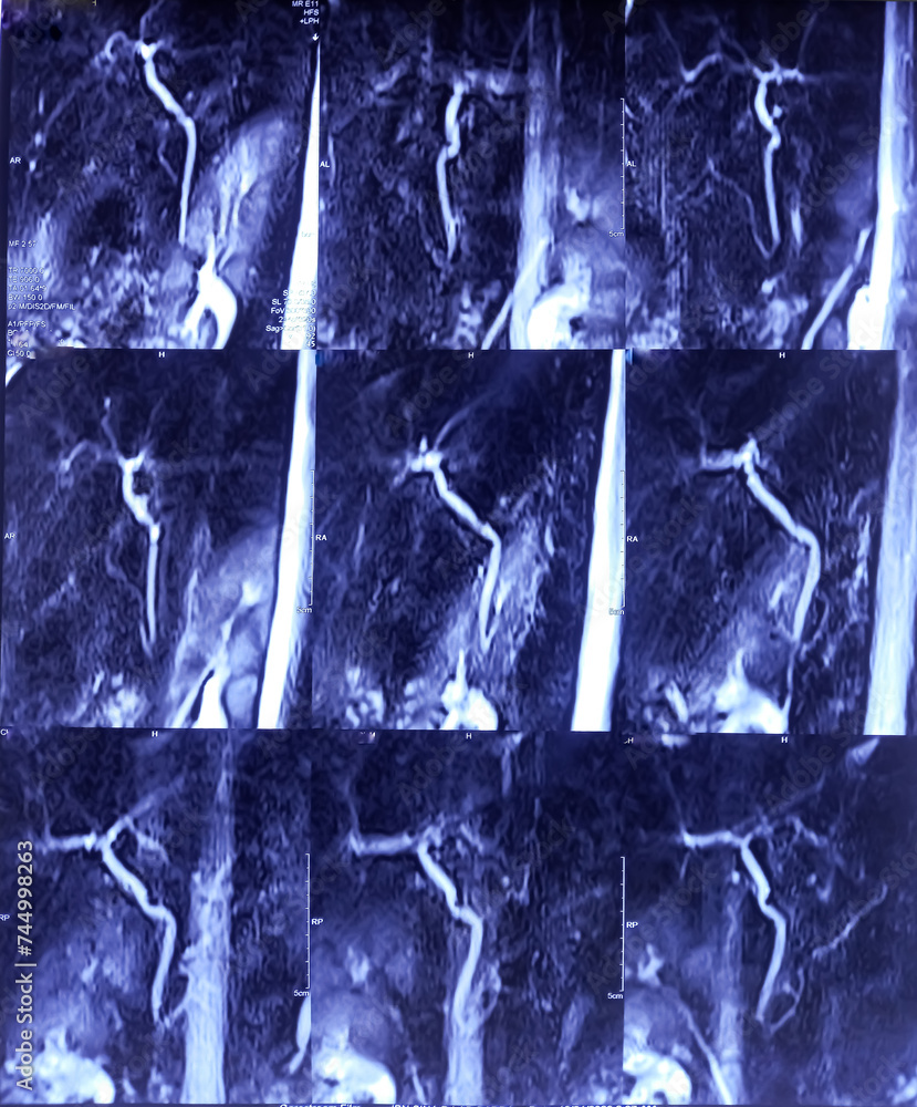 MRCP film of MRI of abdomen. Tiny granular calculi, hepaticolithiasis ...