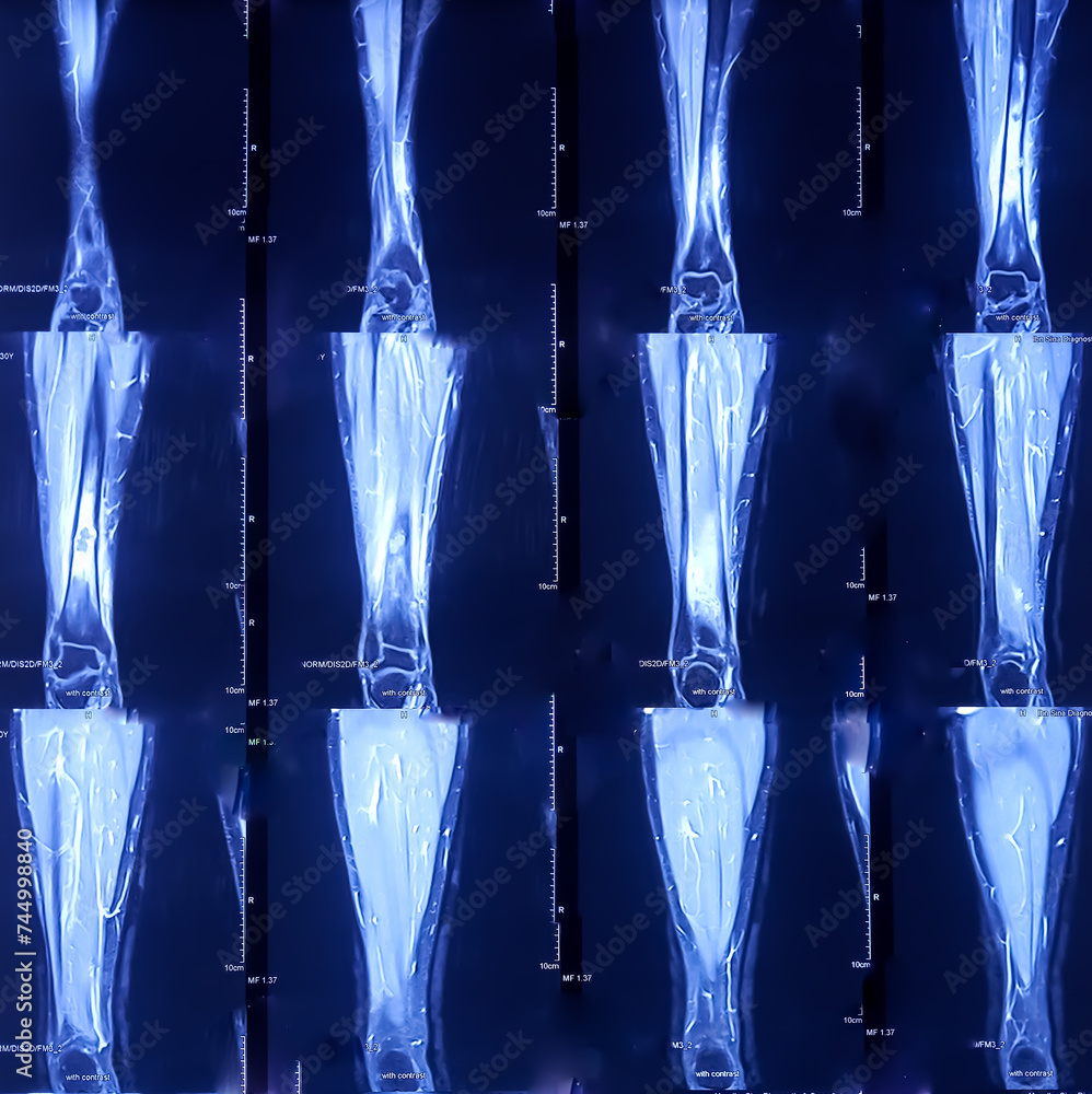 MRI (Magnetic resonance imaging) scan of leg. Lytic bony lesion at ...