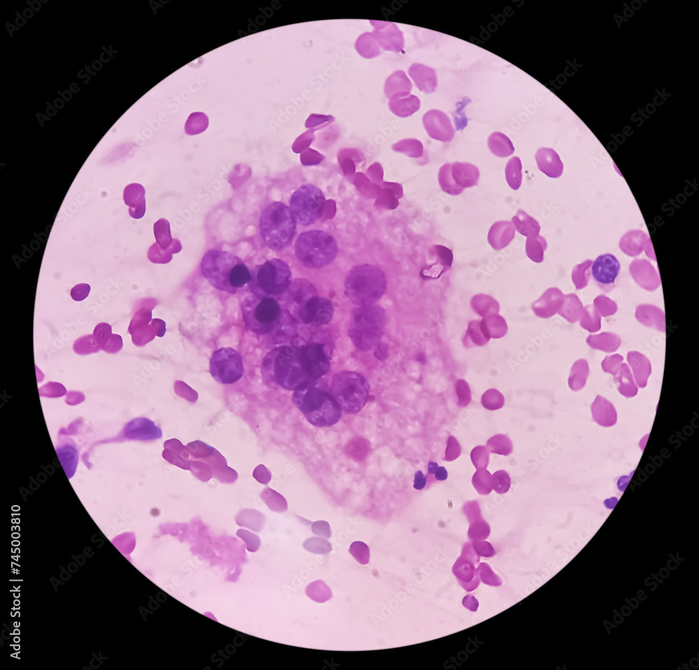 FNA cytology of swelling of chest wall. Infected epidermal inclusion ...