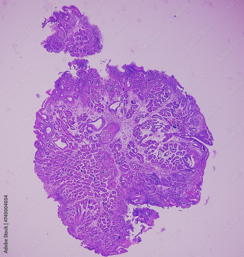 Gastric body tissue (endoscopic biopsy): Section show gastric mucosa ...