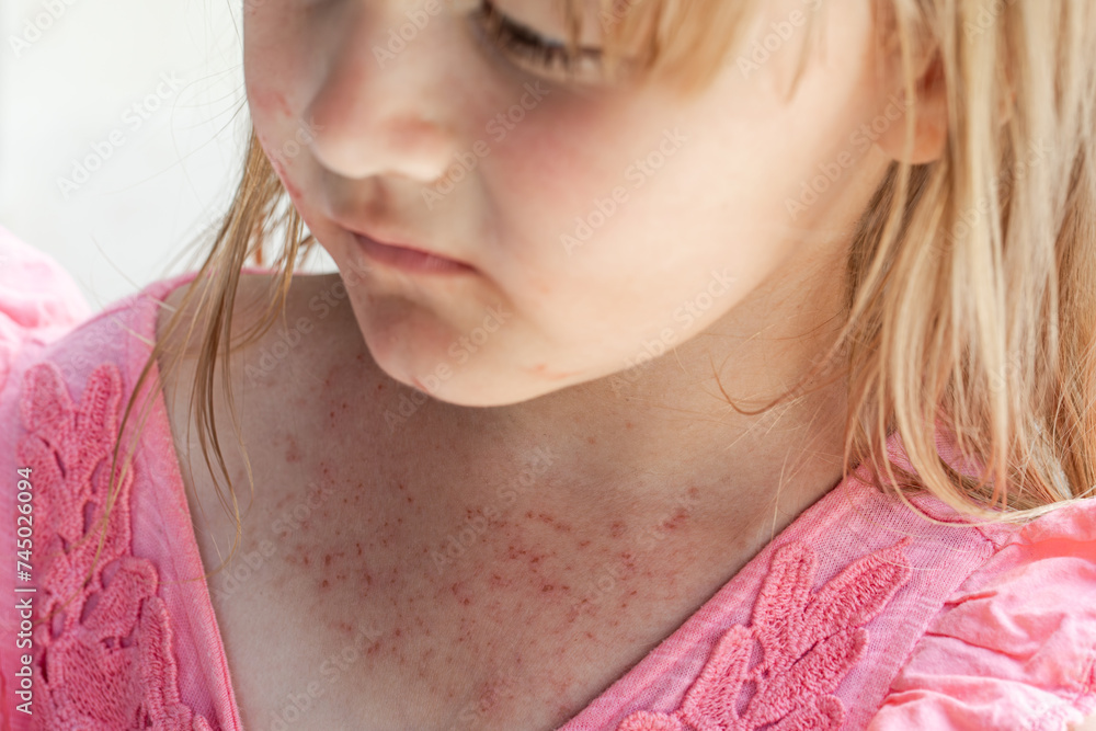 coxsackievirus, Singapore flu, skin rashes, blisters, viral infection ...