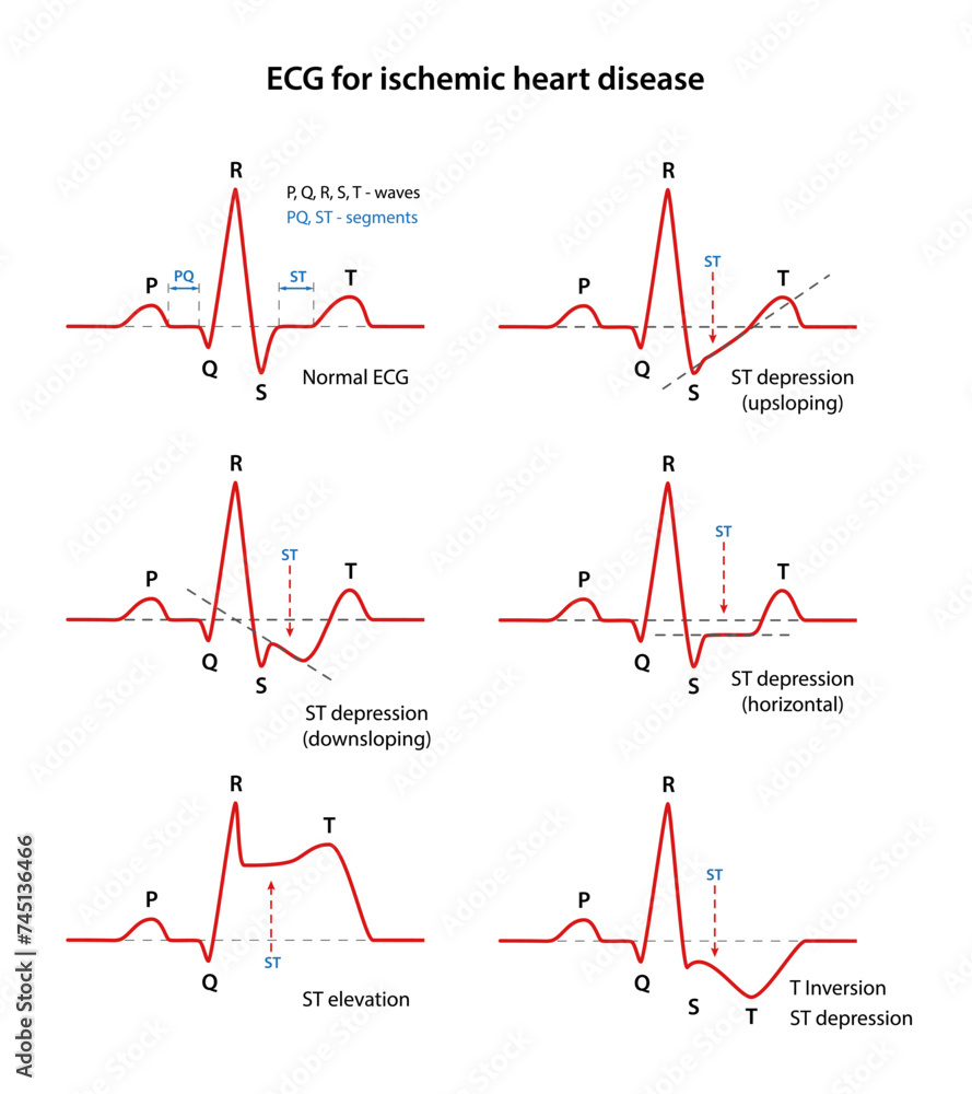 ECG for coronary heart disease. Types of coronary heart disease. Cardiogram of the heart. Vector ...