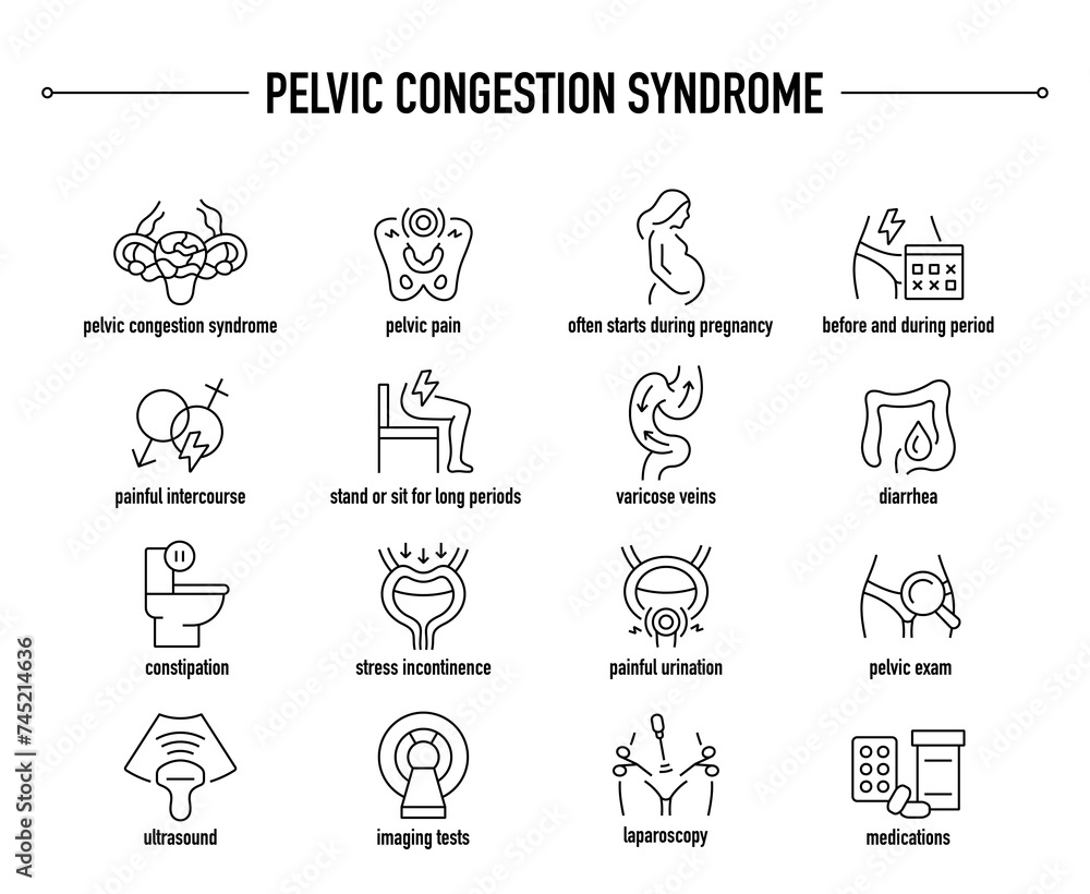 Pelvic Congestion Syndrome symptoms, diagnostic and treatment vector ...
