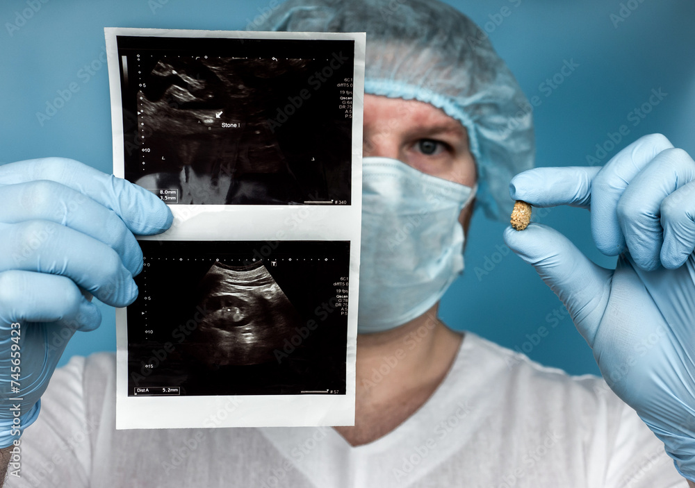 Concrement withdrawn from the kidney with an ultrasound in the doctor's ...