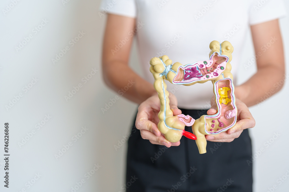 Stock-Foto „Woman holding human Colon anatomy model. Colonic disease ...