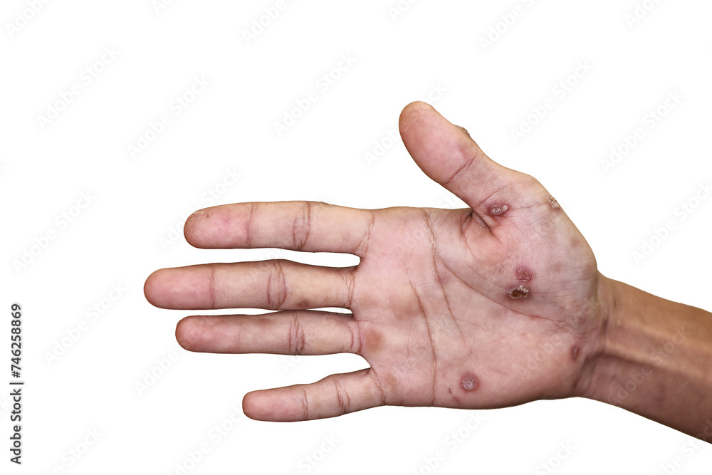 Close up of Secondary stage syphilis sores (lesions) on the palms of ...