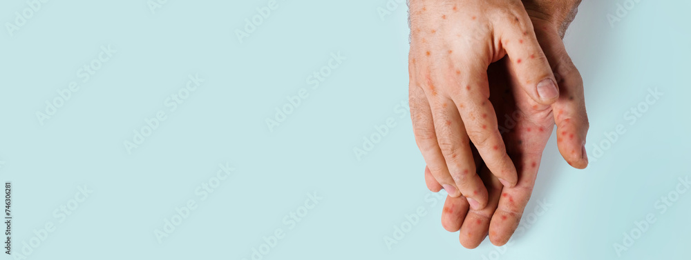 Human Hands with Painful Rash, Red Spots Blisters on the Skin. Health ...
