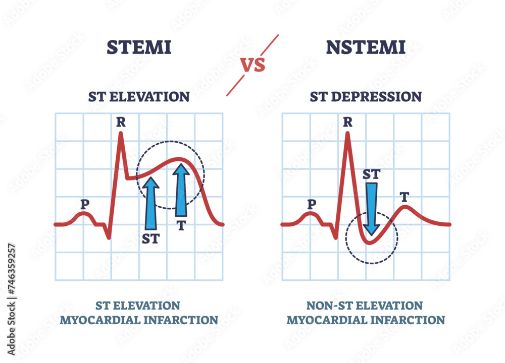 STEMI vs NSTEM heart beat impulse in cardio visualization outline diagram, transparent ...