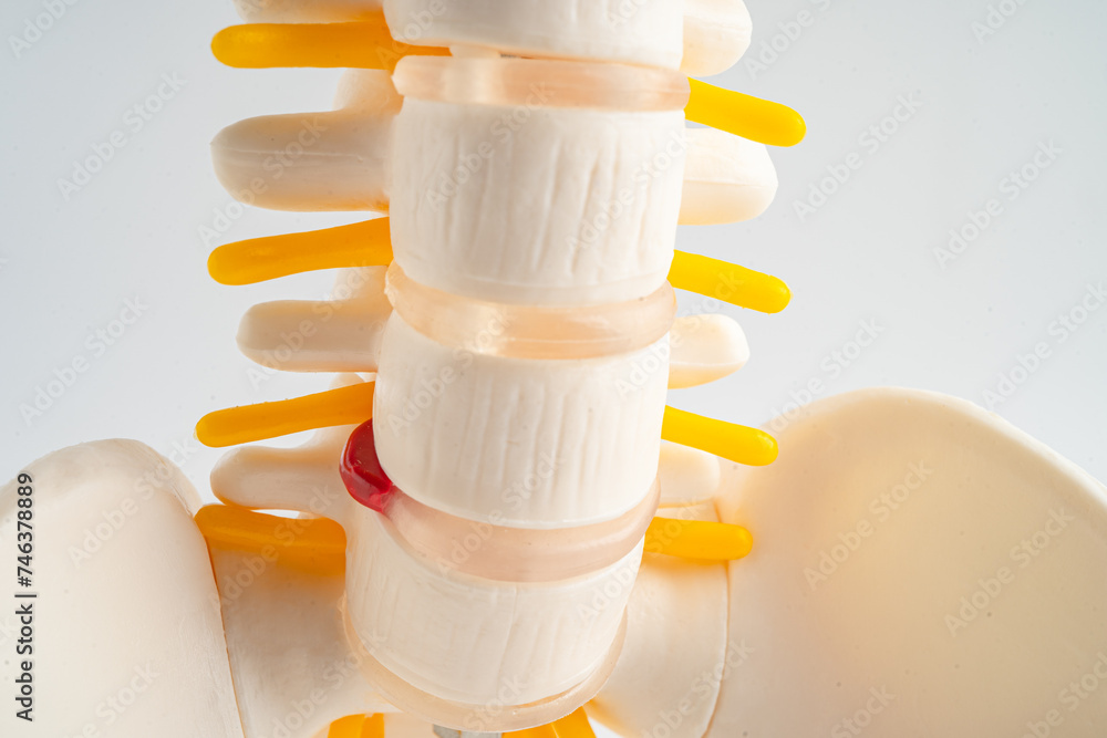 Lumbar spine displaced herniated disc fragment, spinal nerve and bone ...