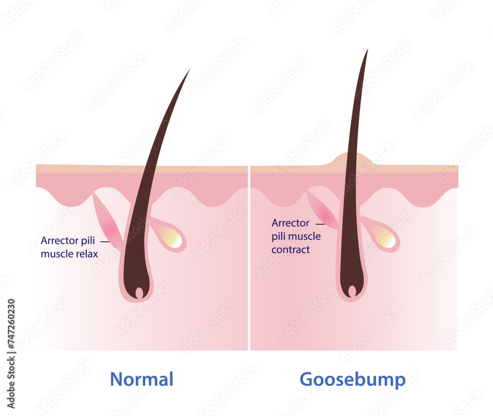 Goosebumps on the skin vector illustration isolated on white background ...
