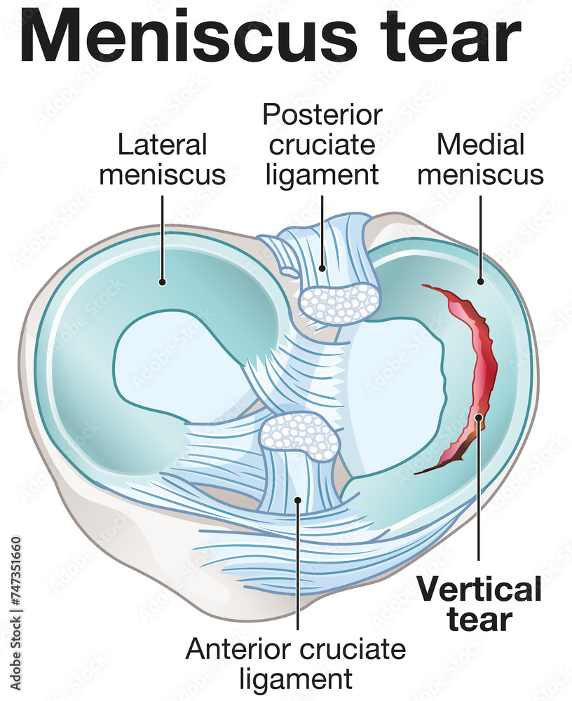 Meniscus tear anatomy. Labeled illustration Stock Illustration | Adobe ...