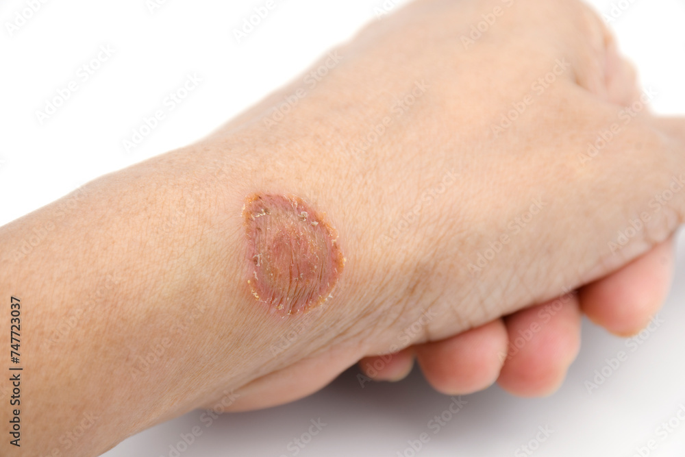 Microsporum canis lesion, a fungus infections on human skin transmitted ...