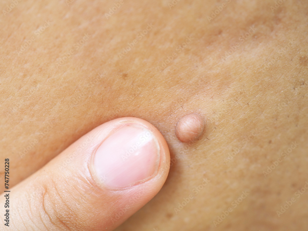 Pink mole on back asian man of skin lesion case of proliferation of ...