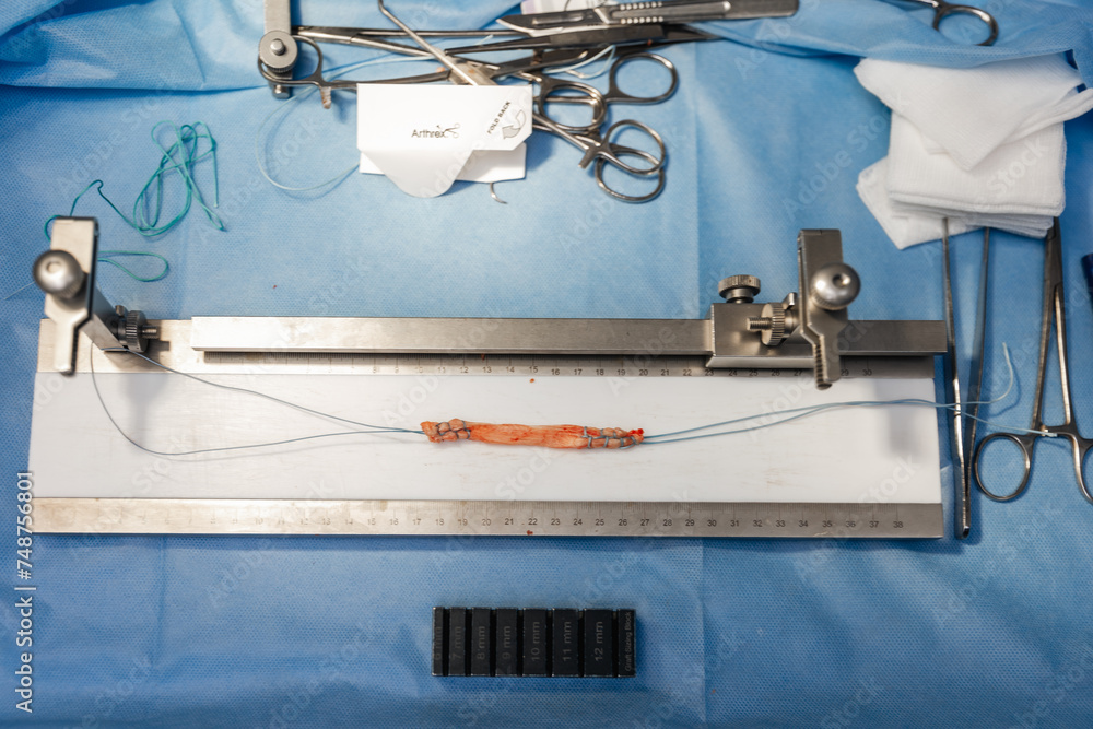 Arthroscopic anterior cruciate ligament reconstruction Stock Photo ...