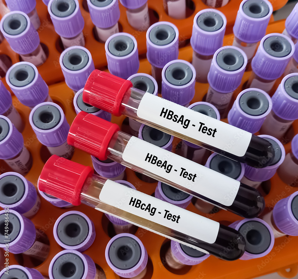 Blood samples for HBsAg, HBeAg and HBcAg test. Hepatitis B Antigen ...