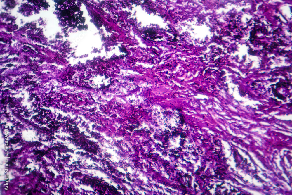 Photomicrograph of lung tissue with silicosis pathology under a ...