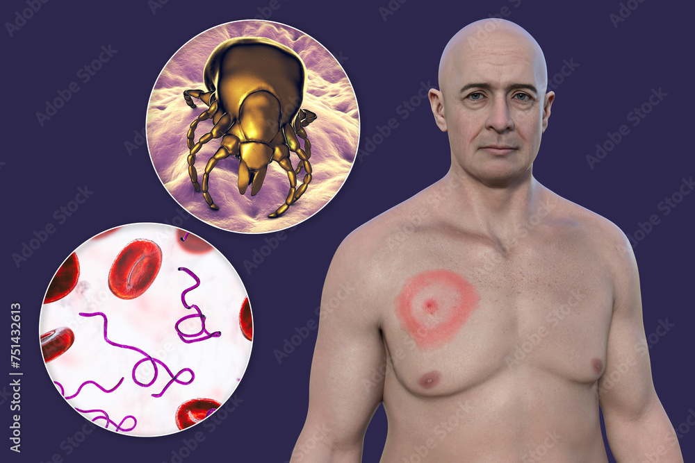 A man with erythema migrans, a characteristic rash of Lyme disease caused by Borrelia ...