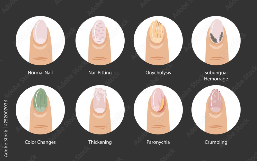 Types of nail pitting disease set collection poster, eight types of ...