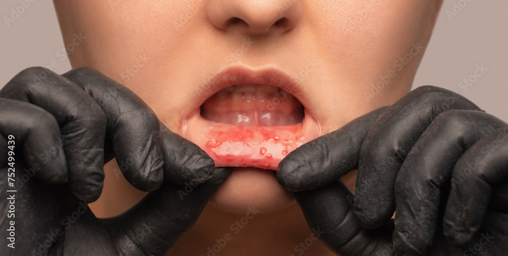 Inflammatory process on the oral mucosa. Stomatitis ulcers on the lips ...