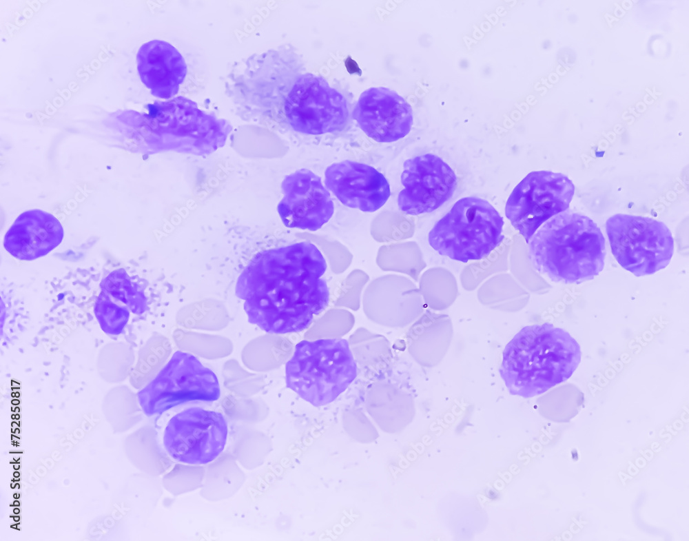 Blood cancer. Photomicrograph of Acute Myeloblastic Leukemia or AML, a ...