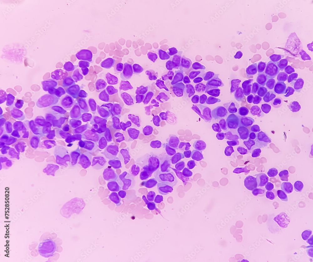 Blood cancer. Photomicrograph of Acute Myeloblastic Leukemia or AML, a ...