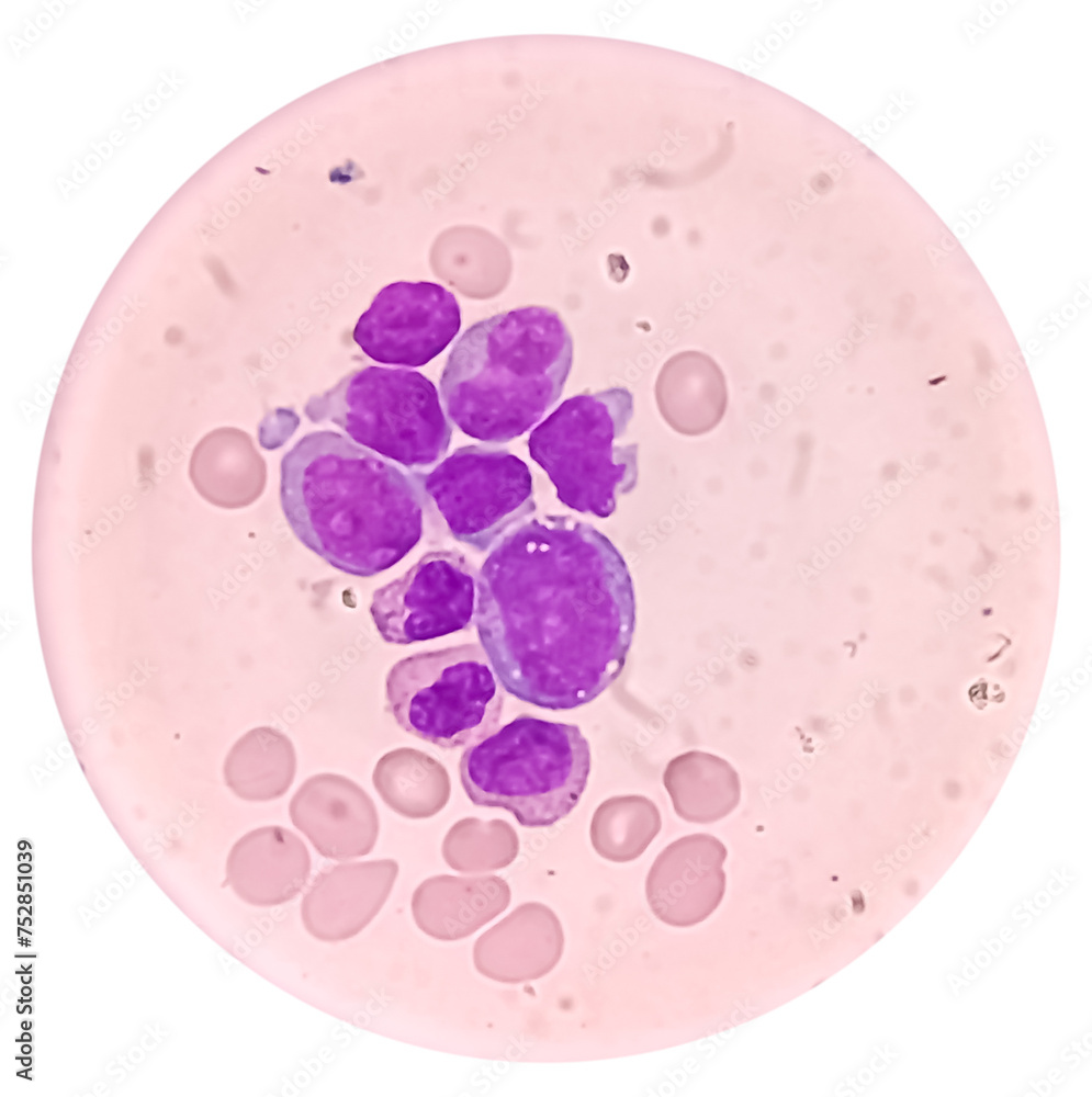 Blood cancer. Photomicrograph of Acute Myeloblastic Leukemia or AML, a ...