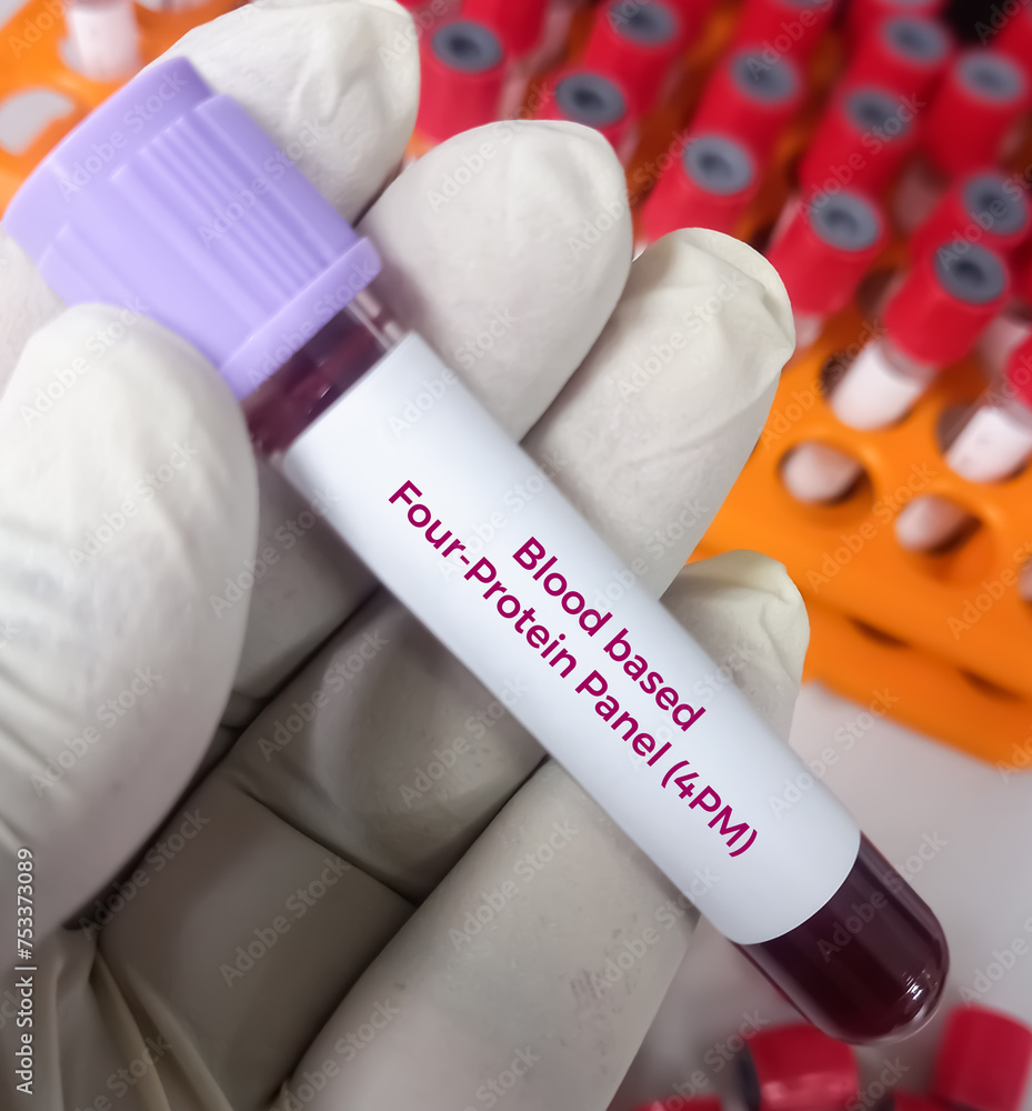 Blood sample for blood-based four-marker protein (4MP) panel, can help ...