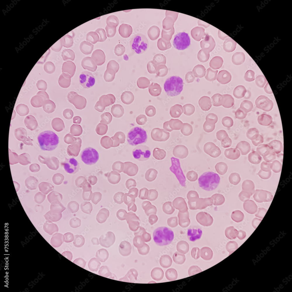 Leukemia. Photomicrograph of hematological blood slide showing ...