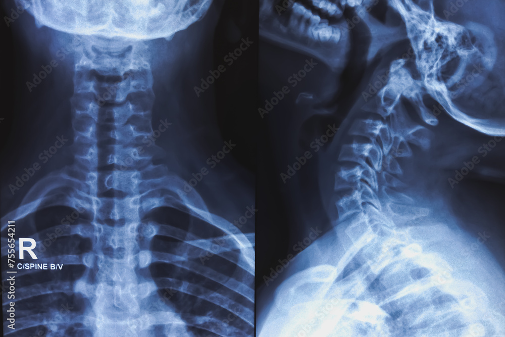 Стоковое фото «Photo of human neck X-ray image. X-ray of cervical spine ...