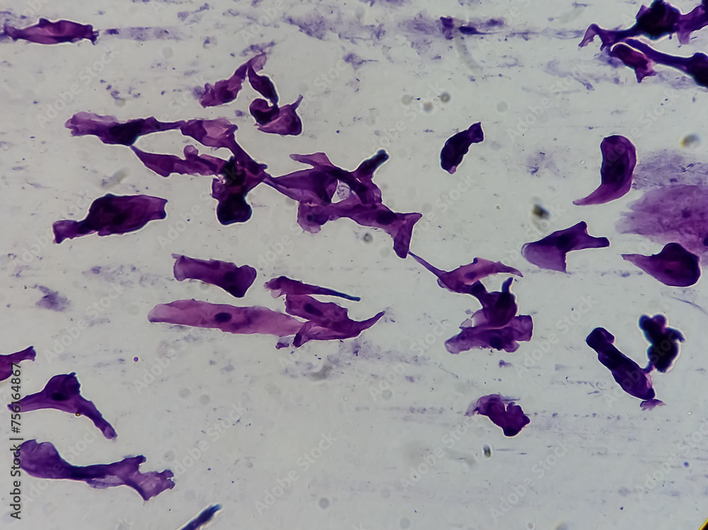 Light micrograph of a vaginal smear showing adenocarcinoma cells ...