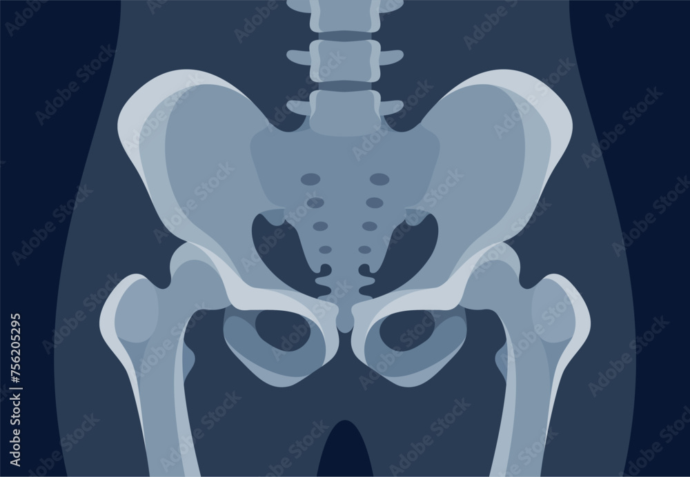 Vector de Stock Xray of hip joint pelvis human bones anatomy orthopedic ...