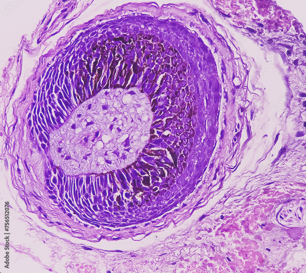 Tissue from axilla (biopsy). Invasive squamous cell carcinoma. Smear ...