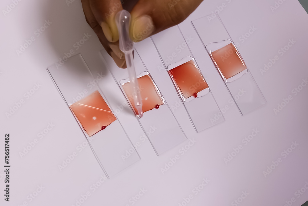 Technician preparing blood smear for sickling test to diagnosed Sickle ...