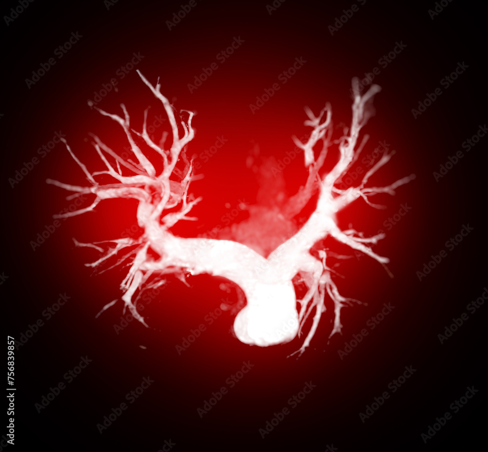 CTA Chest or CTPA with contrast media 3D rendering for diagnostic ...