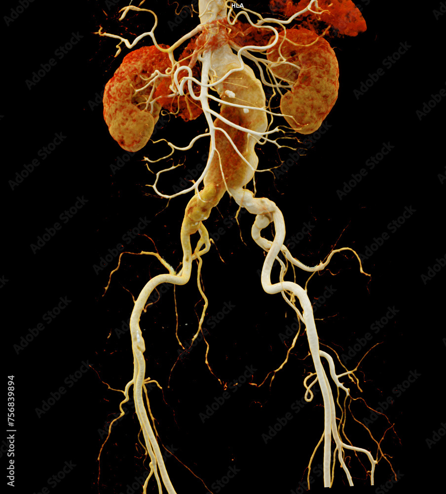 CTA abdominal aorta showing abdomenal aortic dissection 3D rendering ...