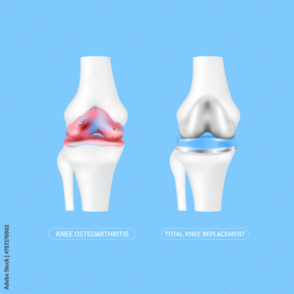Leg bone osteoarthritis or cartilage severe arthritis knee and Total ...