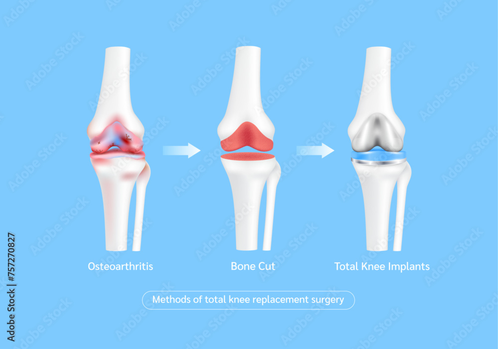 Methods of total knee replacement surgery or implant. Osteoporosis or ...